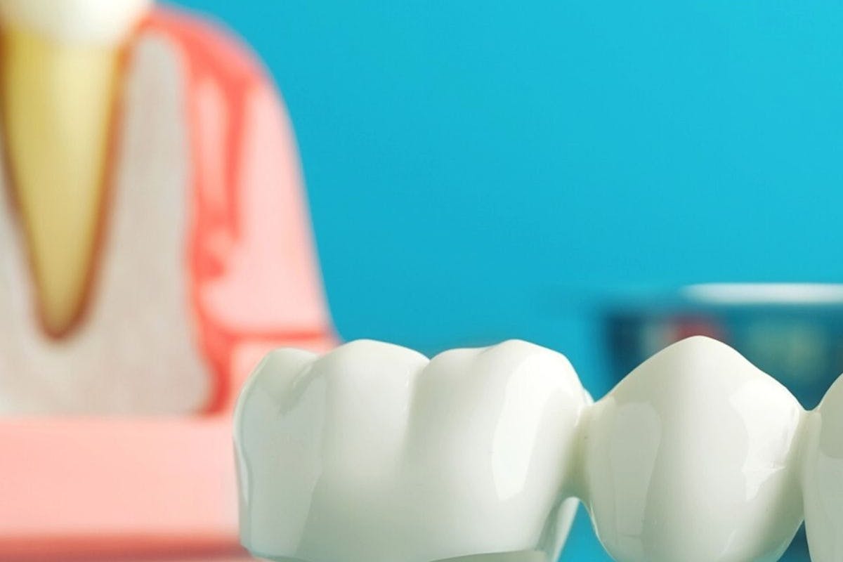 How to Prepare for Your Dental Implant Procedure in Reno - MN Dental Lab